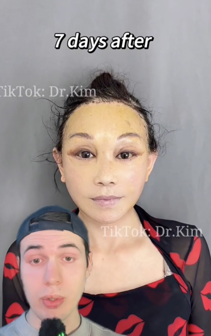 Who Is Dr Kim Plastic Surgeon TikTok Alleged Scary Facelift Surgeries?