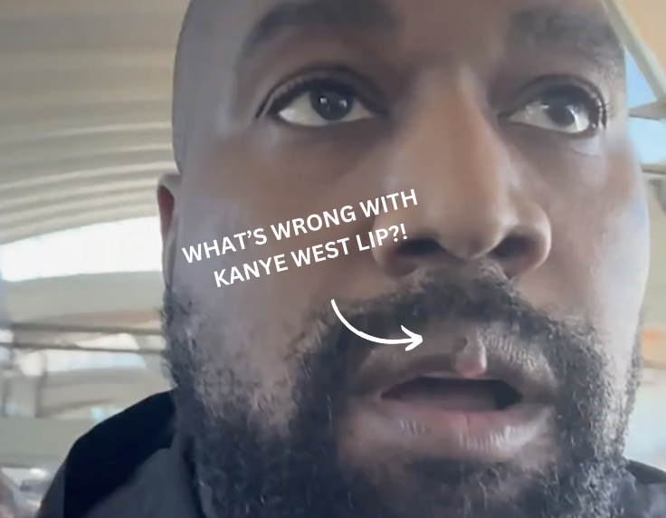 What's Wrong With Kanye West Lip?