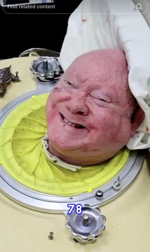 What Happened To Paul Alexander Cause of Death?