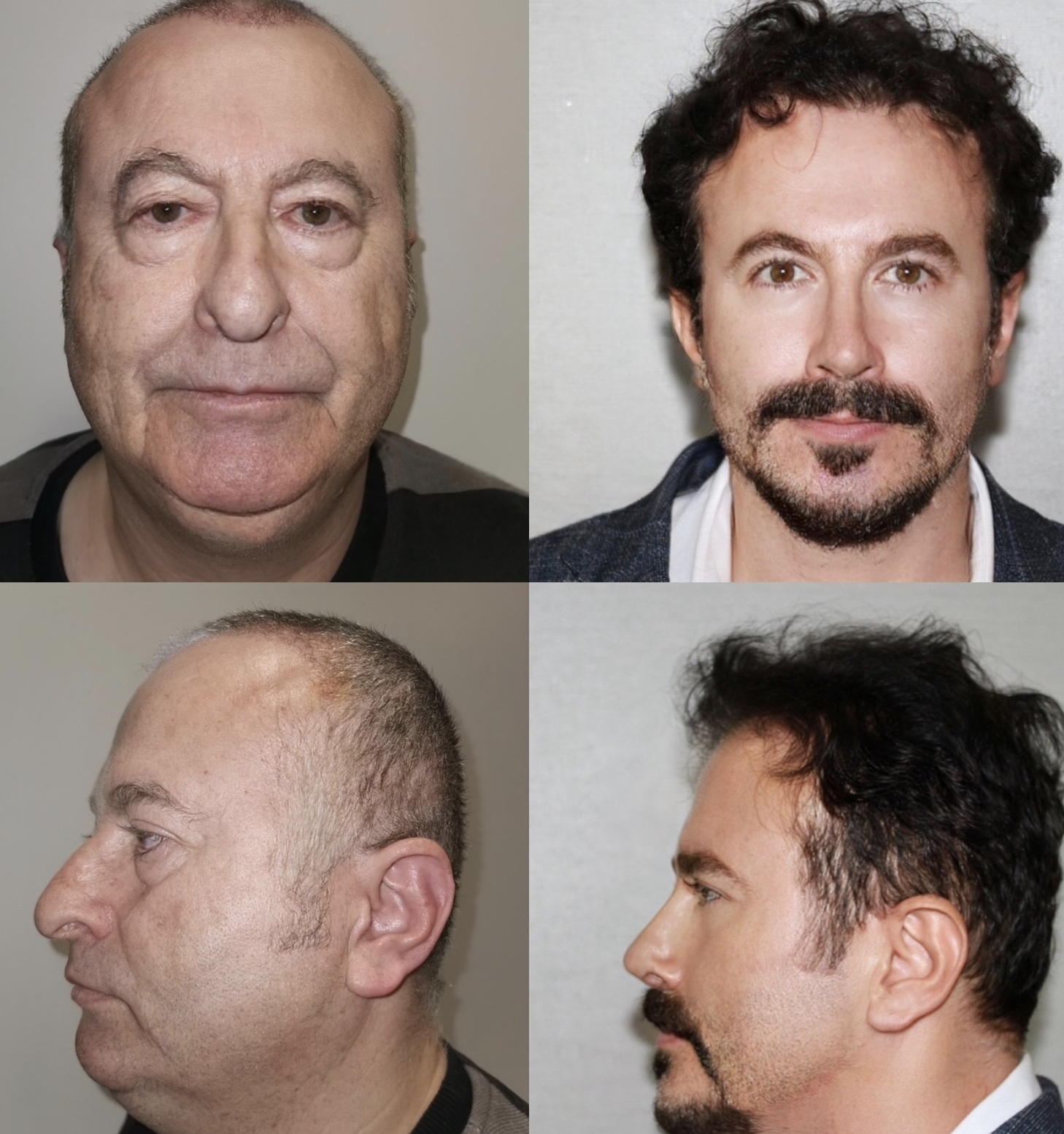 Turkey Plastic Surgery Man Before And After Photo Reddit Viral