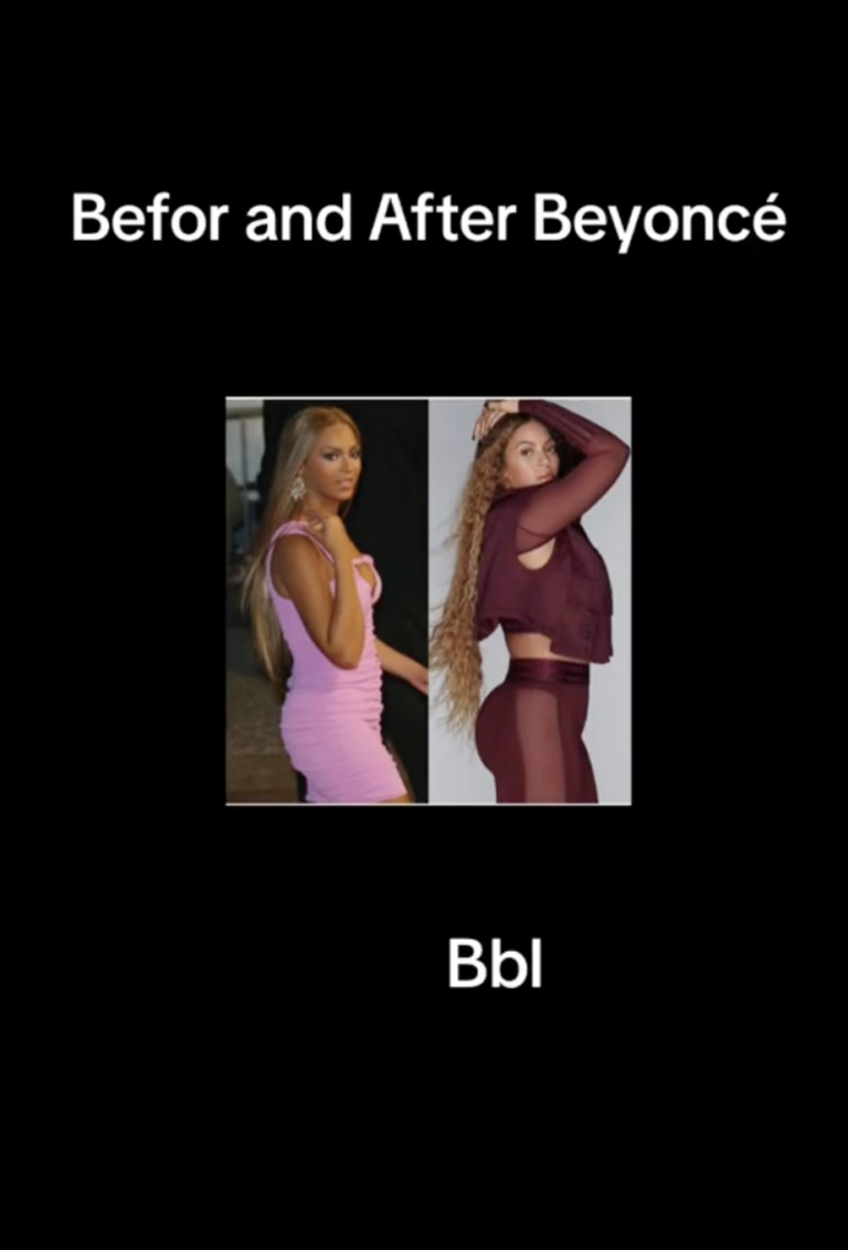 Did Beyonce Get A BBL?