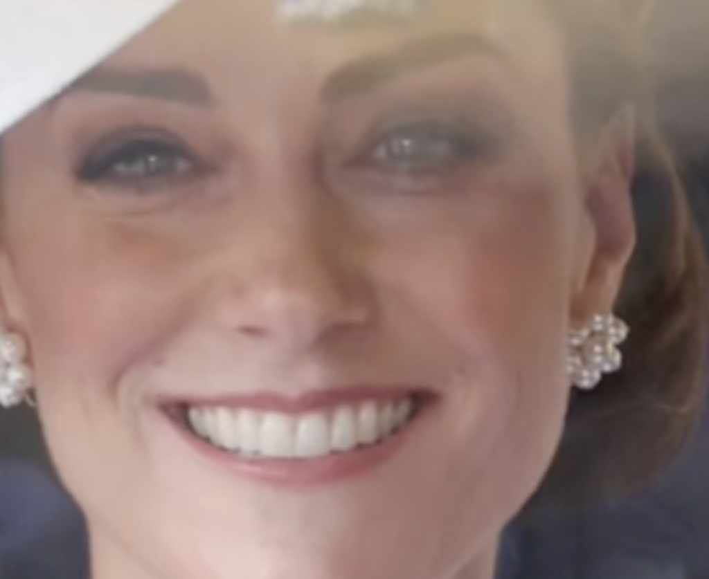 Did Kate Middleton Get A Facelift Before and After
