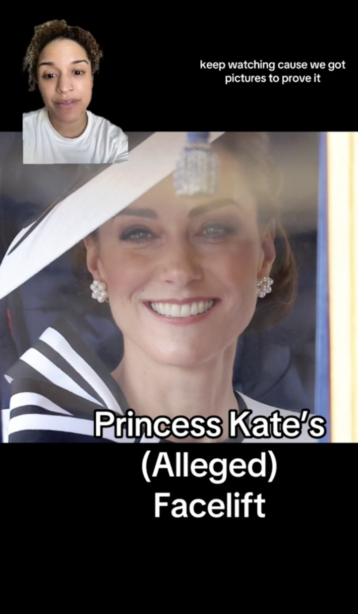 Did Kate Middleton Get A Facelift Before and After