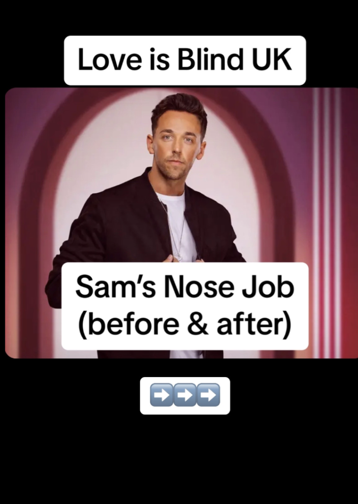 Sam Love Is Blind UK Nose Job Before And After