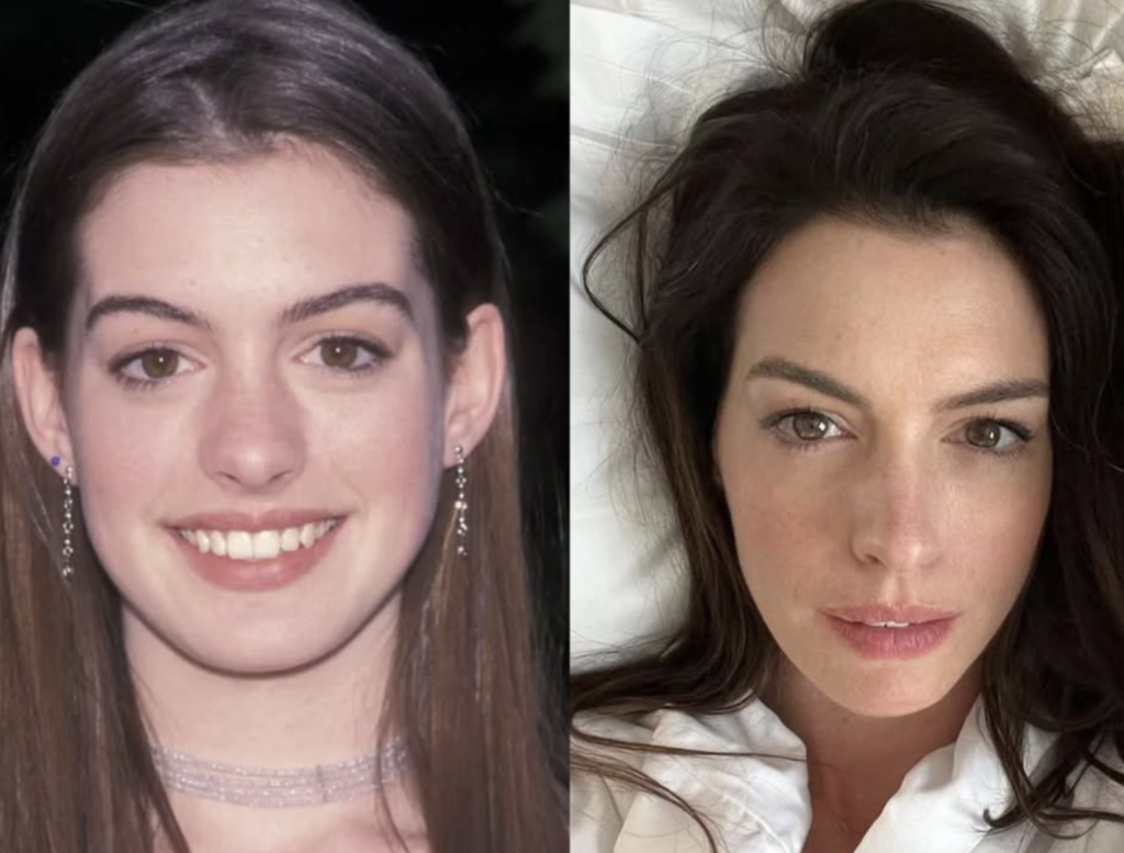 Anne Hathaway Facelift Plastic Surgery Photo Rumors